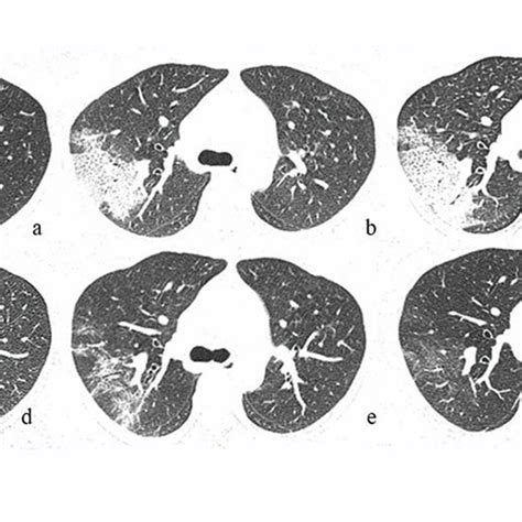 Sars Cov 2 Ct Scan Dataset Sample Images Download Scientific Diagram