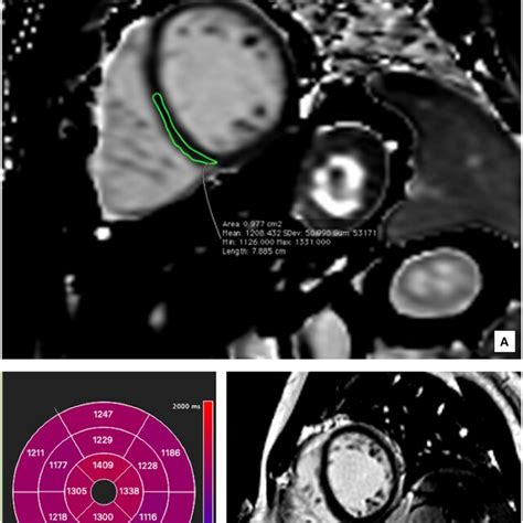 Representative Native T1 Mapping Image And The Corresponding Late
