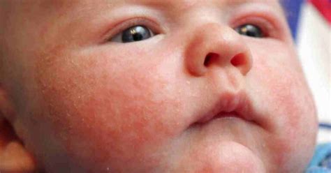 Tcm For Seborrheic Dermatitis More Than 10 Yucky Herbs Are Needed To