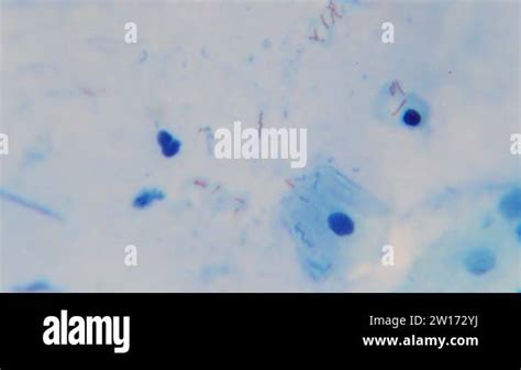 Mycobacterium Tuberculosis Bacteria In Human Sputum Under Microscope Stock Video Footage Alamy