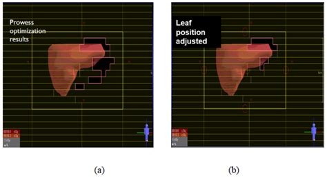 Mlc Leaf Adjustment For Direct Aperture Optimization Treatment Planning