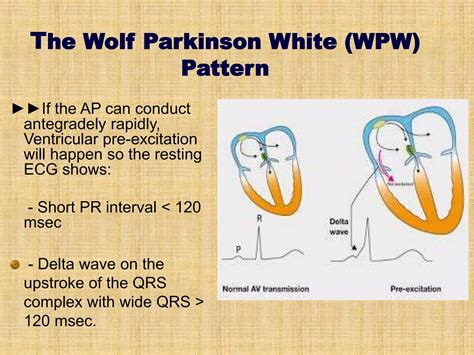 Asymptomatic Wpw Management Ppt