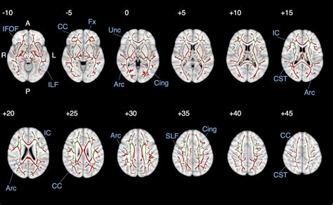 Overview Of Tract Based Spatial Statistics Tbbs Results Comparing