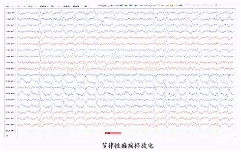 【学术报告整理】结构性癫痫的脑电图特点——复旦大学附属儿科医院神经内科周渊峰副主任医师 脑医汇