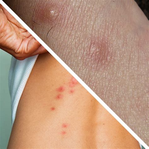 Bed Bug Bites Vs Spider Bites How To Differentiate The Two Bed Bug Sos