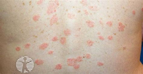 Pityriasis Rosea Image