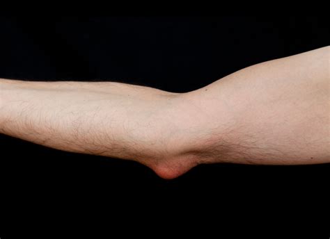 Bursitis Healthify