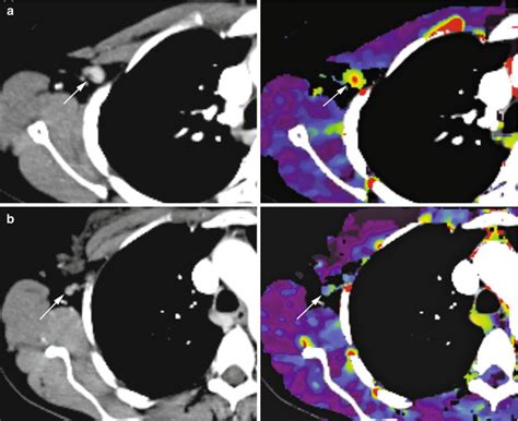 Perfusion CT Principles Technical Aspects And Applications In Oncology Radiology Key