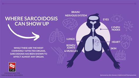 Foundation For Sarcoidosis Research On Linkedin Organs Involved