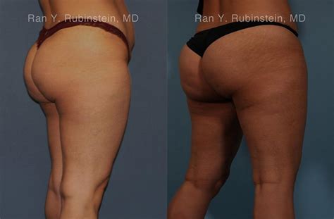 Sculptra Butt Lift In Montvale Nj Dr Ran Y Rubinstein