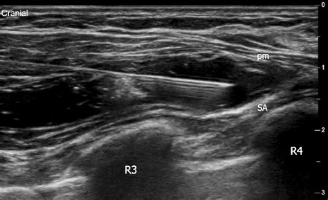 Ultrasound Image Of Second Injection Of Pecs Ii Block Showing Local Download Scientific Diagram