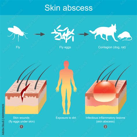 Skin Abscess