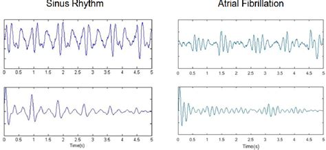 [pdf] Atrial Fibrillation Detection Using Mems Accelerometer Based Bedsensor Semantic Scholar