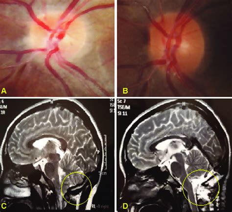 Optic Disc Elevation At Scarlett Tenison Woods Blog