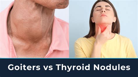 Goiters Vs Thyroid Nodules Key Differences