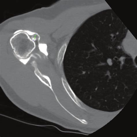 Pdf Subscapularis Tendon Tears Classification Diagnosis And Repair