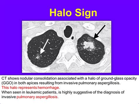 Radiological Signs In Chest Medicine Part 2 Pdf Lung And Respiratory Health Diseases And