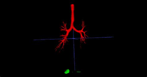 A Ct Based Airway Segmentation Using U2 Net Trained By The Dice Loss