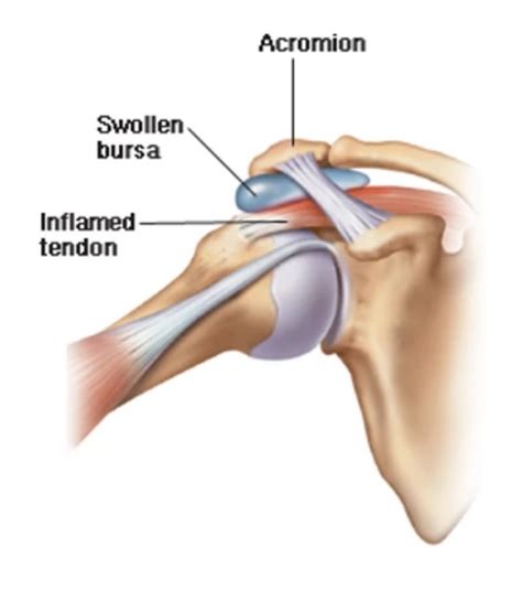 What Is Shoulder Bursitis Physio Fit Adelaide