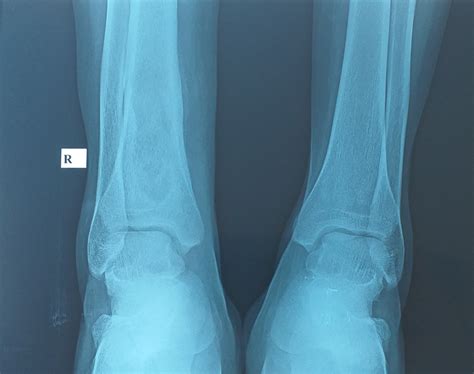 A Lytic Image With Peripheral Condensation In The Lower Third Of The Tibia Download Scientific