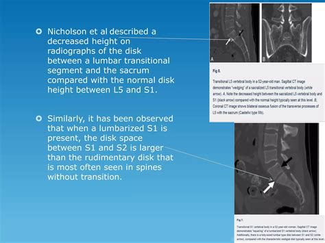 Transitional Vertebrae Radiology Pptx