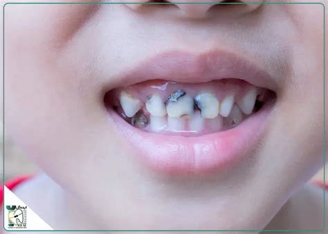 ۱۰ بیماری شایع دهان و دندان کودکان که والدین نگران آن هستند