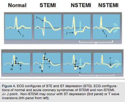 Is This A True Stemi Ecg Typical And Atypical Findings