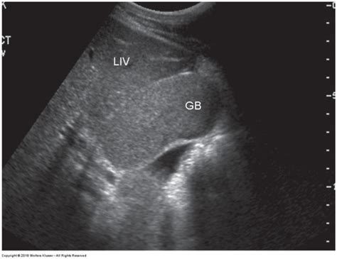 Strawberry Gallbladder Ultrasound