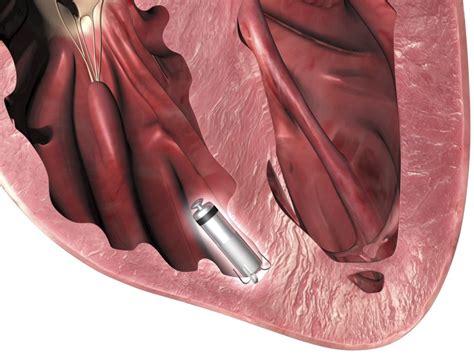 Leadless Pacemakers Associated With Fewer Complications The Cardiology Advisor
