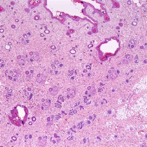 Pdf Congenital Hairy Polyp Of The Soft Palate