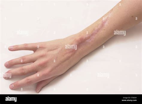 Wrist Scars Hi Res Stock Photography And Images Alamy