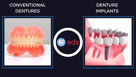 Why Denture Implants Are Better Than Conventional Dentures Emergency