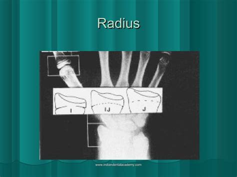 Skeletal Maturity Indicators Endodontic Courses Ppt Bone And Joint Conditions Diseases And