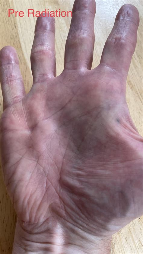 Update After Radiation Treatment R Dupuytrendisease