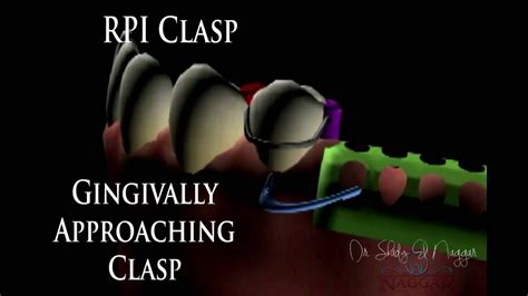 Rpi Design Partial Denture At Michael Siddons Blog