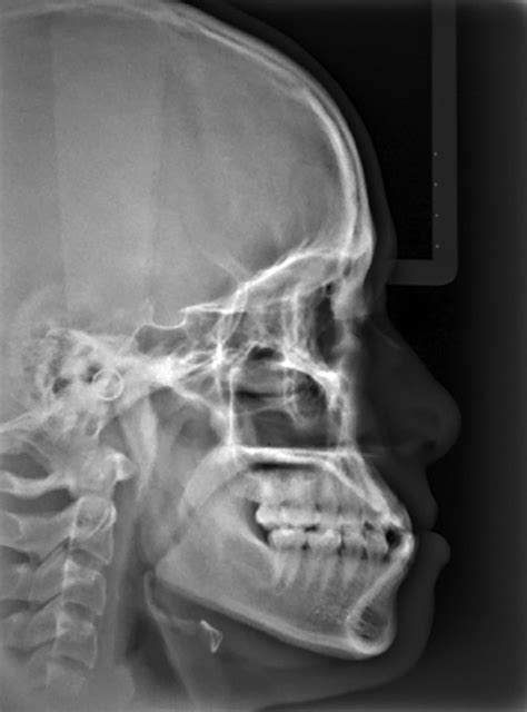 Non Surgical Compensation Of Skeletal Class Iii Malocclusions Oral Health Group