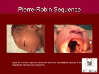 Syndromes Ppt