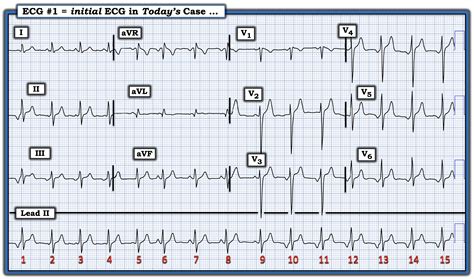 Ecg Interpretation 2025