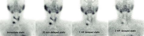 Sequential Planar Static Images Post Technetium 99m Sestamibi