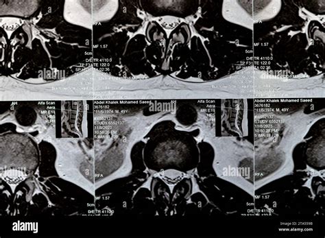 Cairo Egypt November 14 2023 Mri Of Lumbosacral Spine Revealed L3 L4