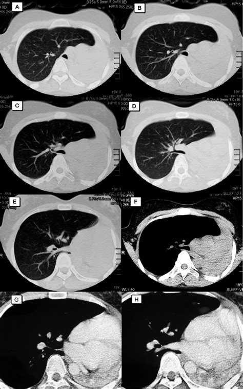 Unilateral Pulmonary Opacity With Herniation Of Contralateral Lung To