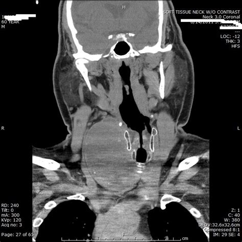 Thyroid Surgery Photos