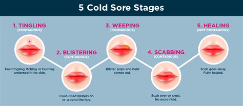 Cold Sores Are Contagious Until Fully Healed Shine365 From Marshfield Clinic