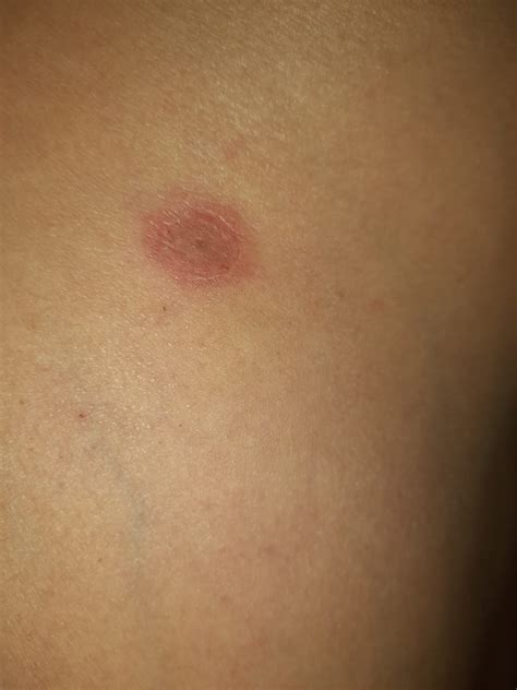 What Is The Best Treatment For Persistent Ringworm Rdermatologyquestions