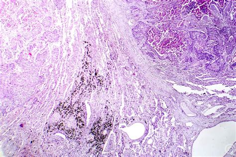 Carcinoma Squamoso Delle Cellule Del Micrografo A Luce Polmonare