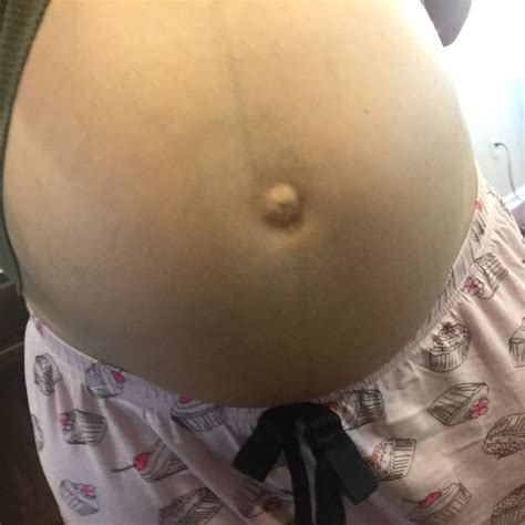 Is This A Regular Popped Belly Button Or A Umbilical Hernia Glow