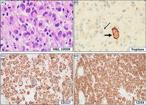 A 61‐year‐old Man With Mandibular Bone Mast Cell Sarcoma The