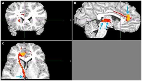 Pregenual Anterior Cingulate Cortex Pgacc To Lhb Tract The Fiber Download Scientific Diagram