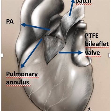 Comparison Of Different Pulmonary Valve Reconstruction Techniques