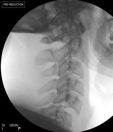 Facet Joint Dislocation The Bone School